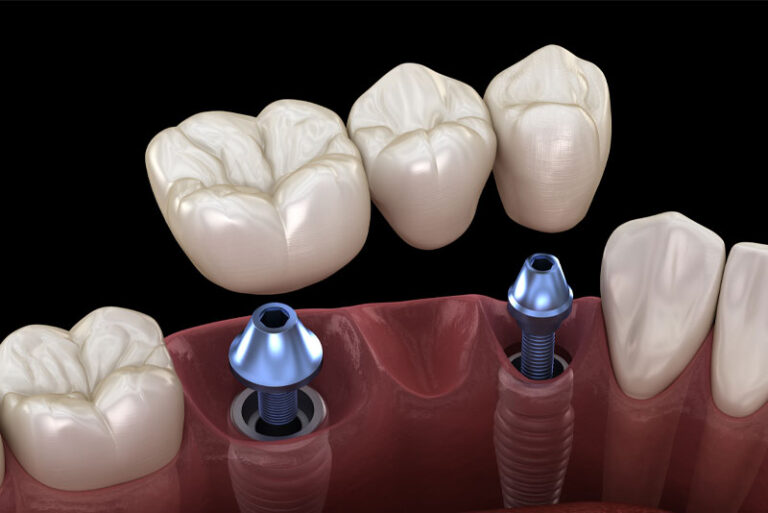 Dental Implant Options | All On 4 Full Mouth Implants | Leo-Cedarville, IN